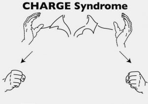ASL Sign for CHARGE « Charge Syndrome Foundation