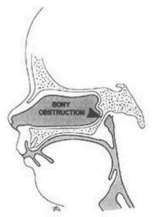 Factsheet about Choanal Atresia or Stenosis « Charge Syndrome Foundation