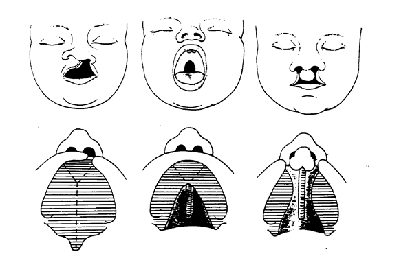 Cleft Lip +/- Cleft Palate « Charge Syndrome Foundation